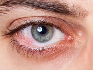 Gerötete Augen: Ursachen & Linderung | Bepanthen®